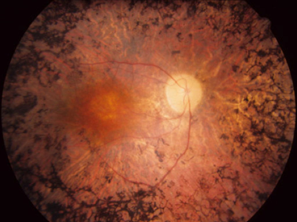 Retinal diseases - Dr. Marco Lombardo eye doctor in Rome